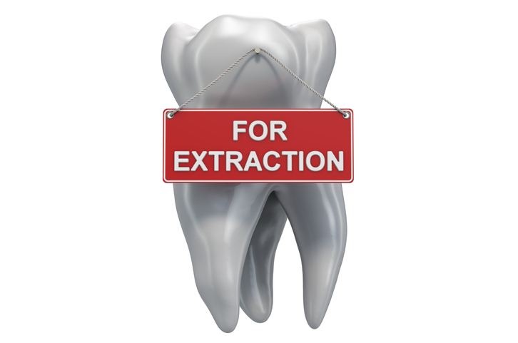 Pain free Tooth extraction in Houston, at Pulse Dental